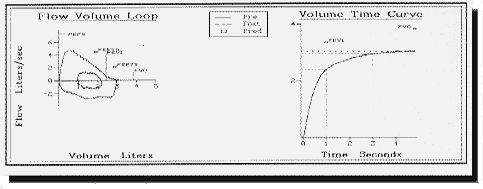 Flow Volume Curves No 1.